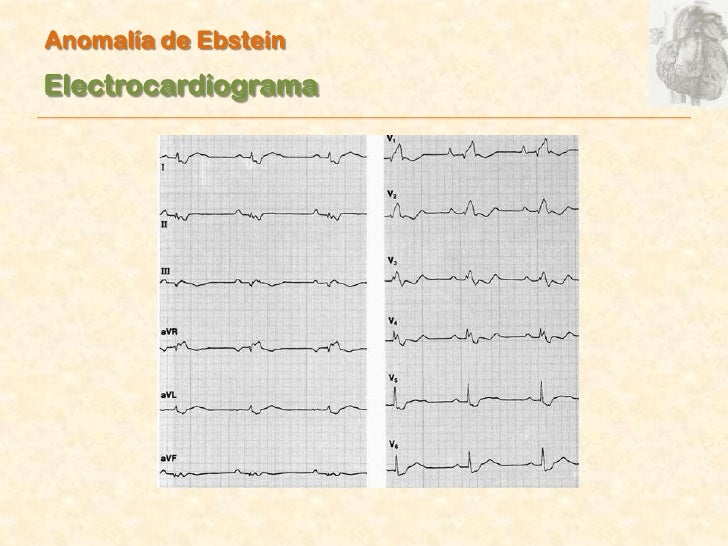 Anomalía de Ebstein