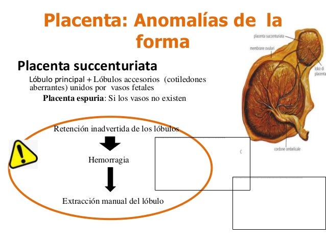 Placenta Succenturiata
