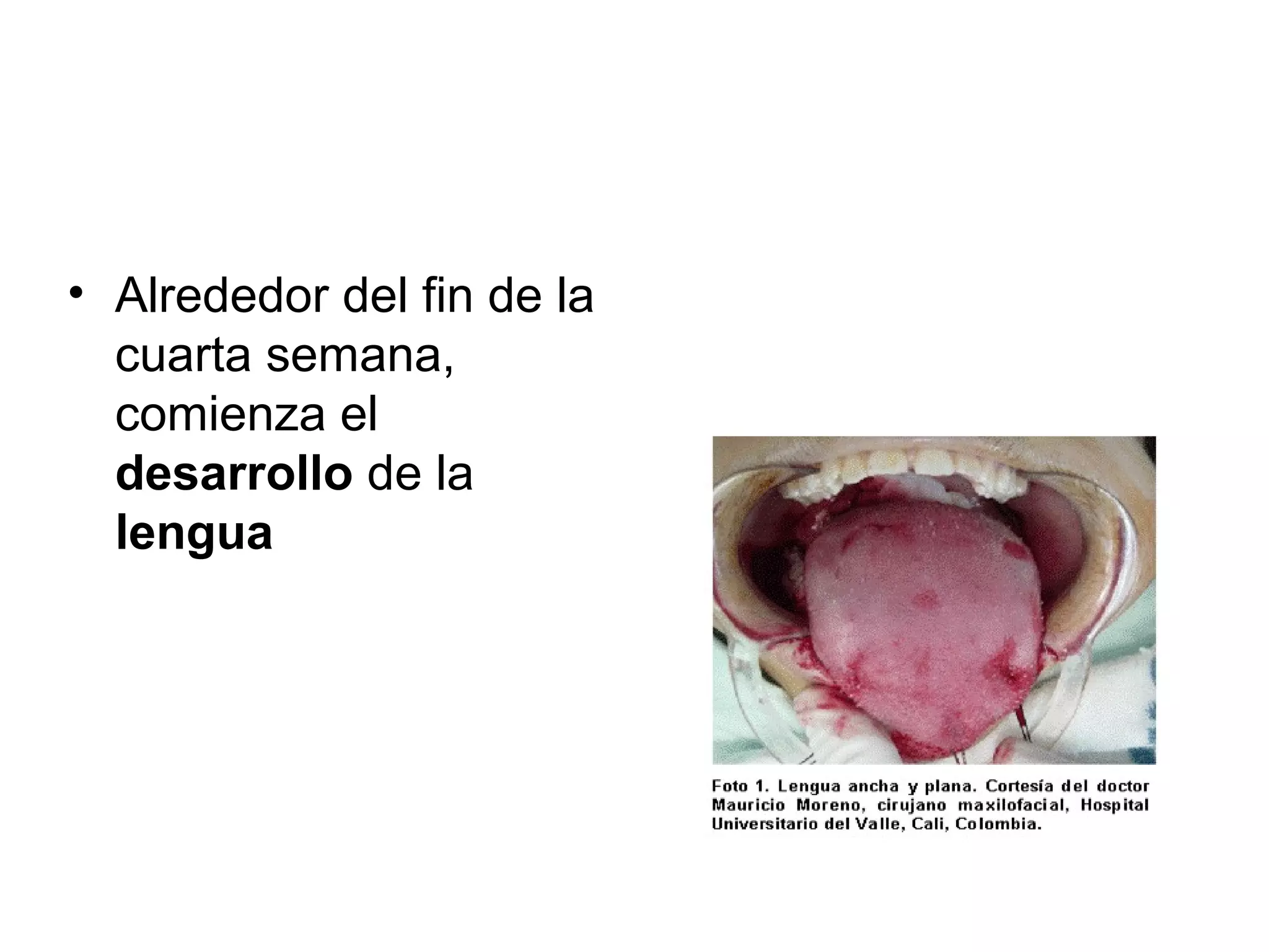 Anomalías del desarrollo de la lengua | PPT