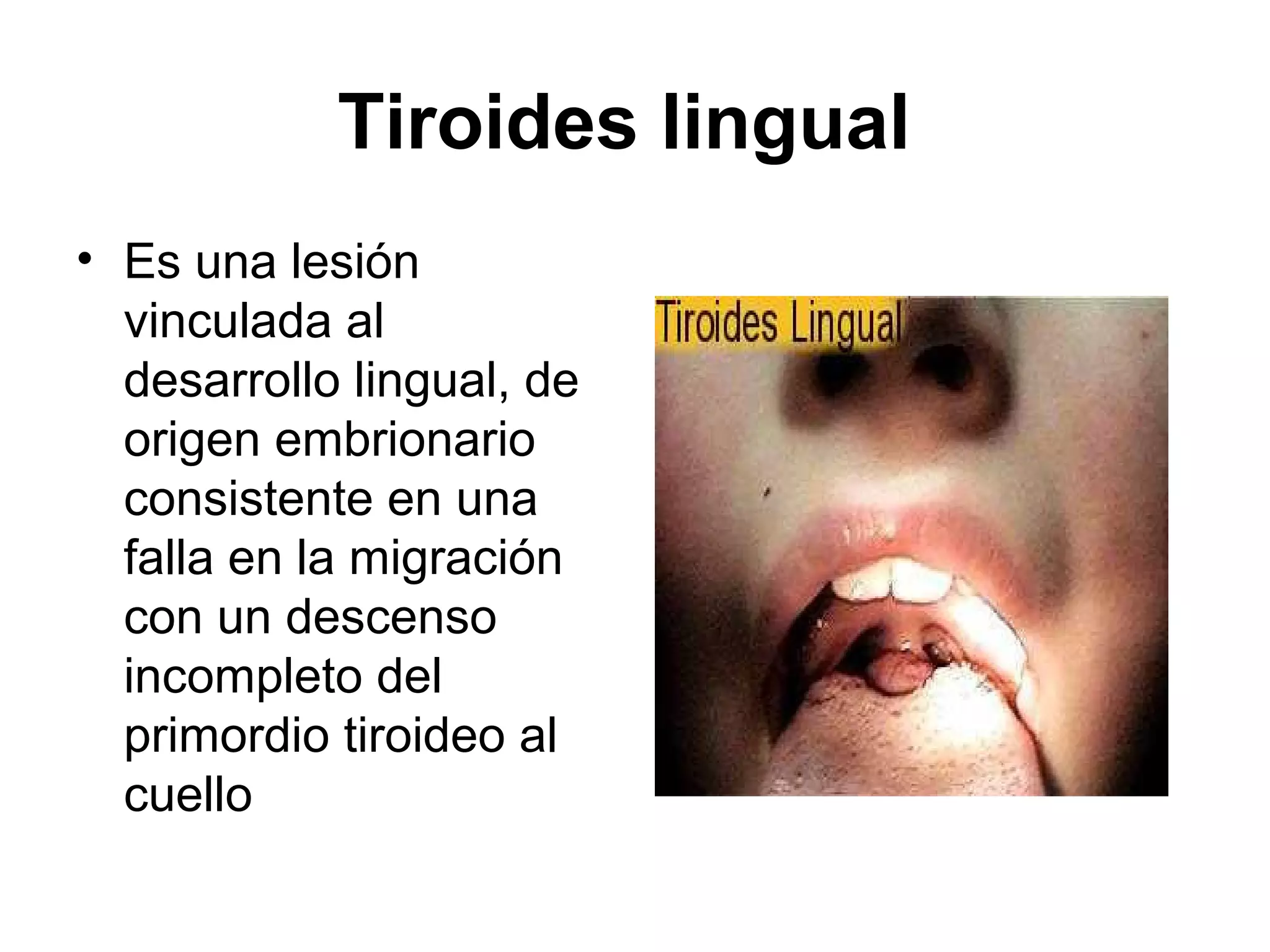 Anomalías del desarrollo de la lengua | PPT
