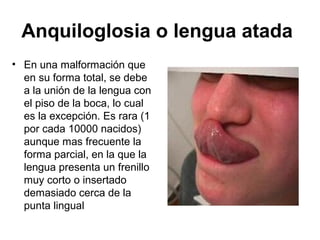 Anomalías del desarrollo de la lengua | PPT