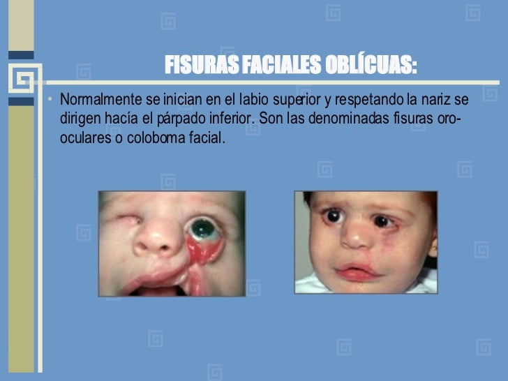 Anomalias Craneofaciales
