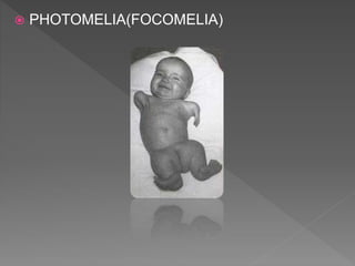 Anomalias congenitas del desarrollo | PPTX | Blood Disorders | Diseases ...