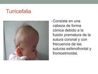 Anomalías congénitas del sistema nervioso central | PPTX