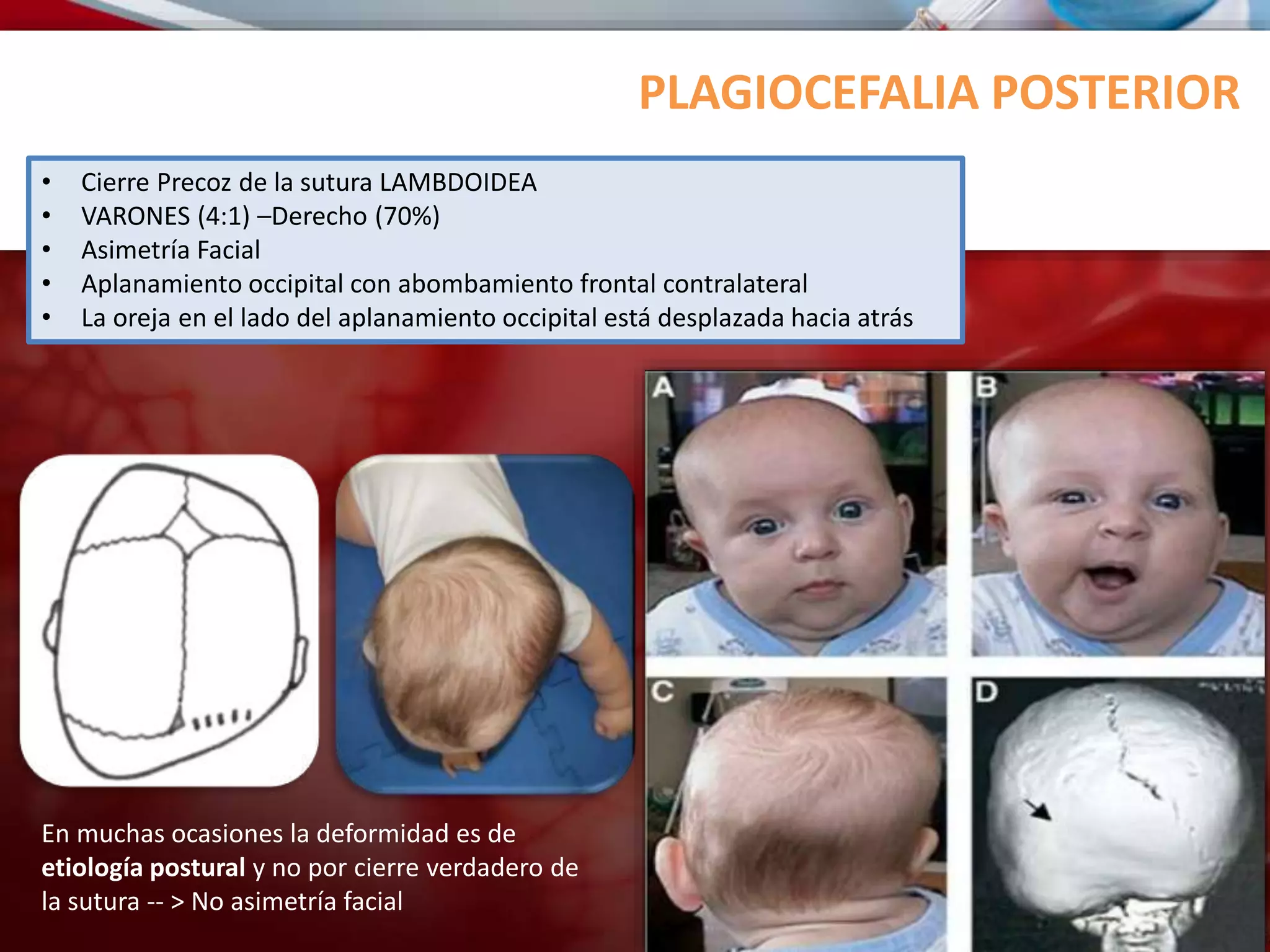 Anomalias del desarrollo(craneosinostosis y bifidismo craneal) | PPT