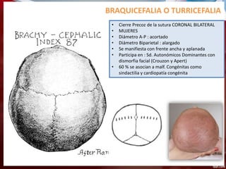 Anomalias del desarrollo(craneosinostosis y bifidismo craneal) | PPTX
