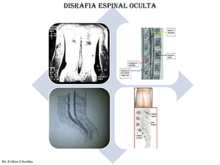 Anomalias del desarrollo vertebral - Neurocirugía | PPTX