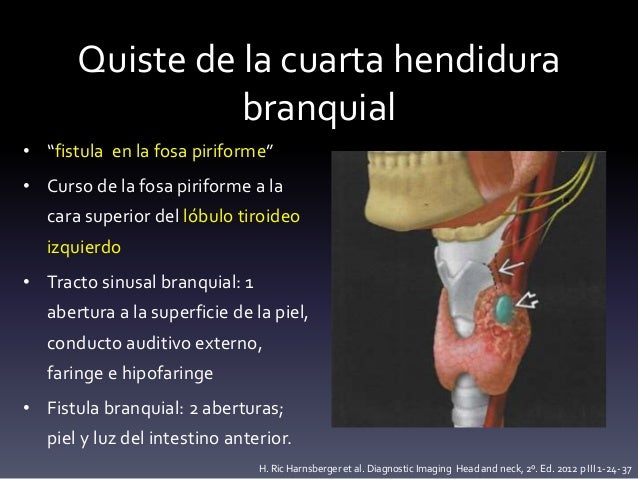 Quistes los arcos branquiales