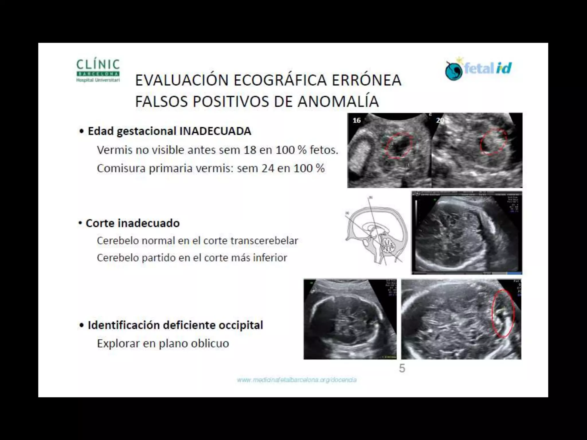 Anomalias del SNC Fetal. Ultrasonografia | PPT