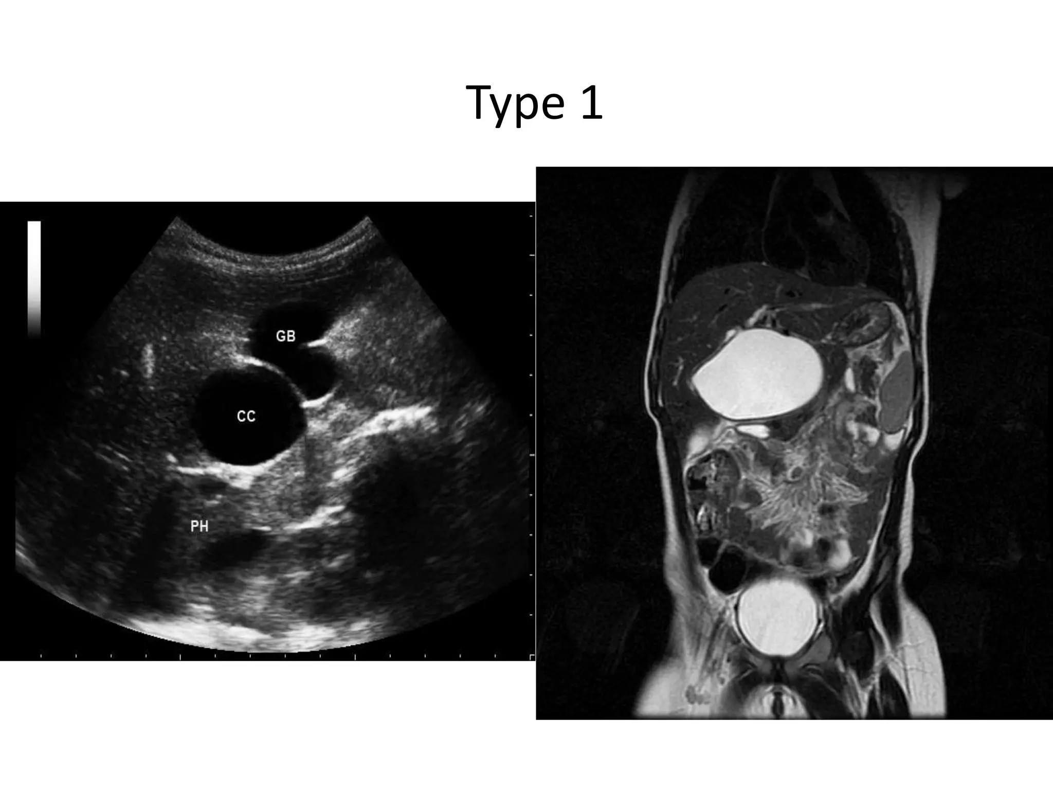 Anomalies of biliary tree | PPTX