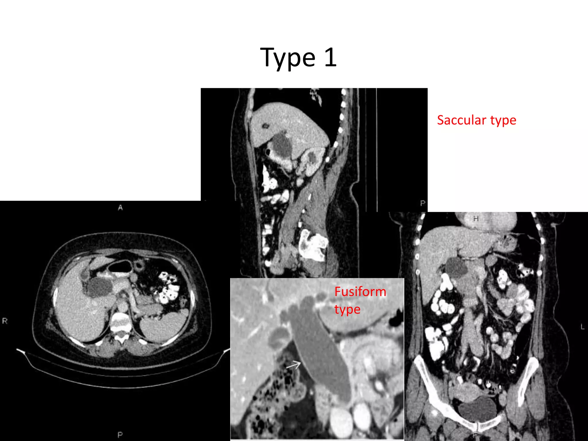 Anomalies of biliary tree | PPTX