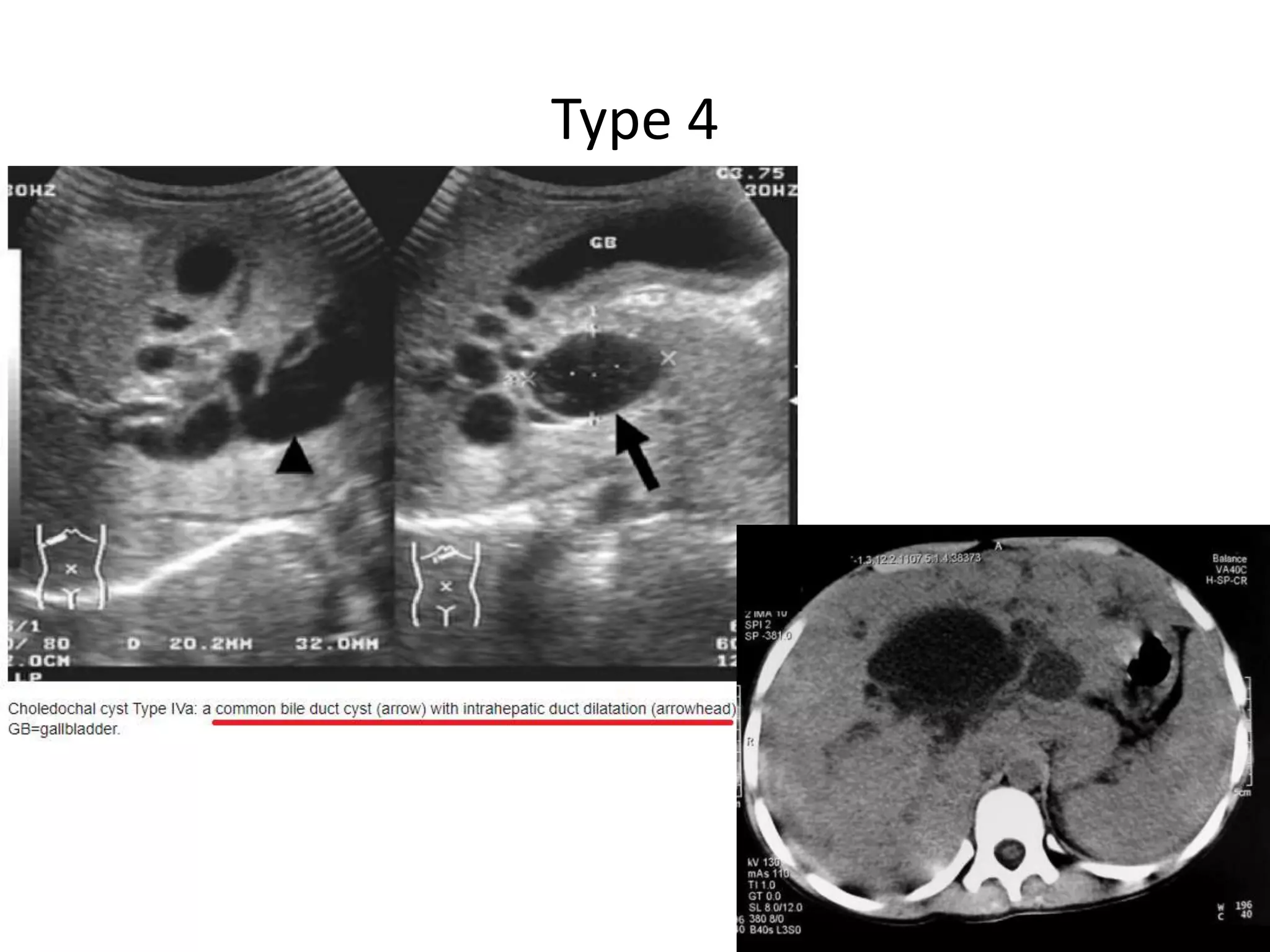 Anomalies of biliary tree | PPTX