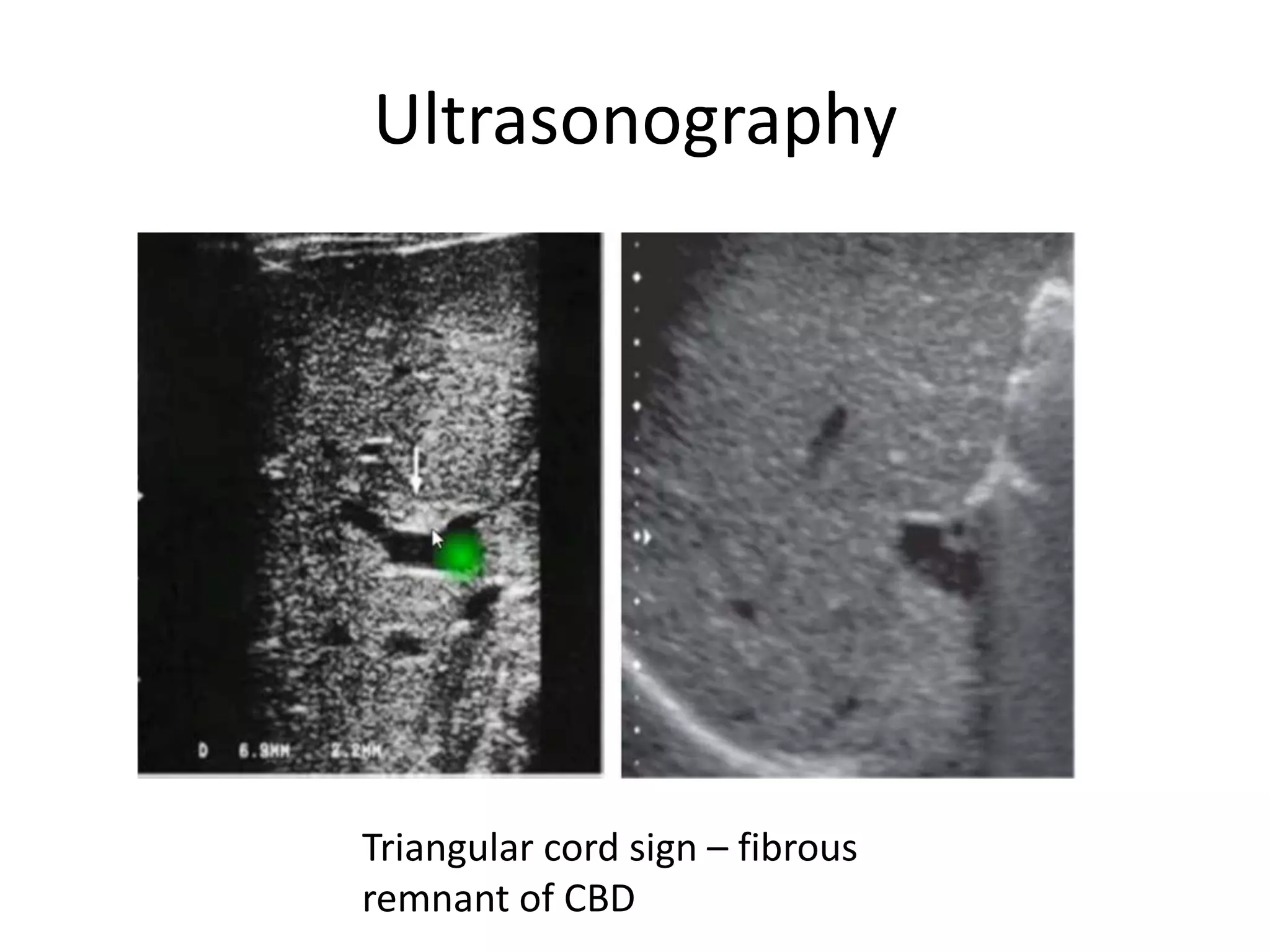 Anomalies of biliary tree | PPTX