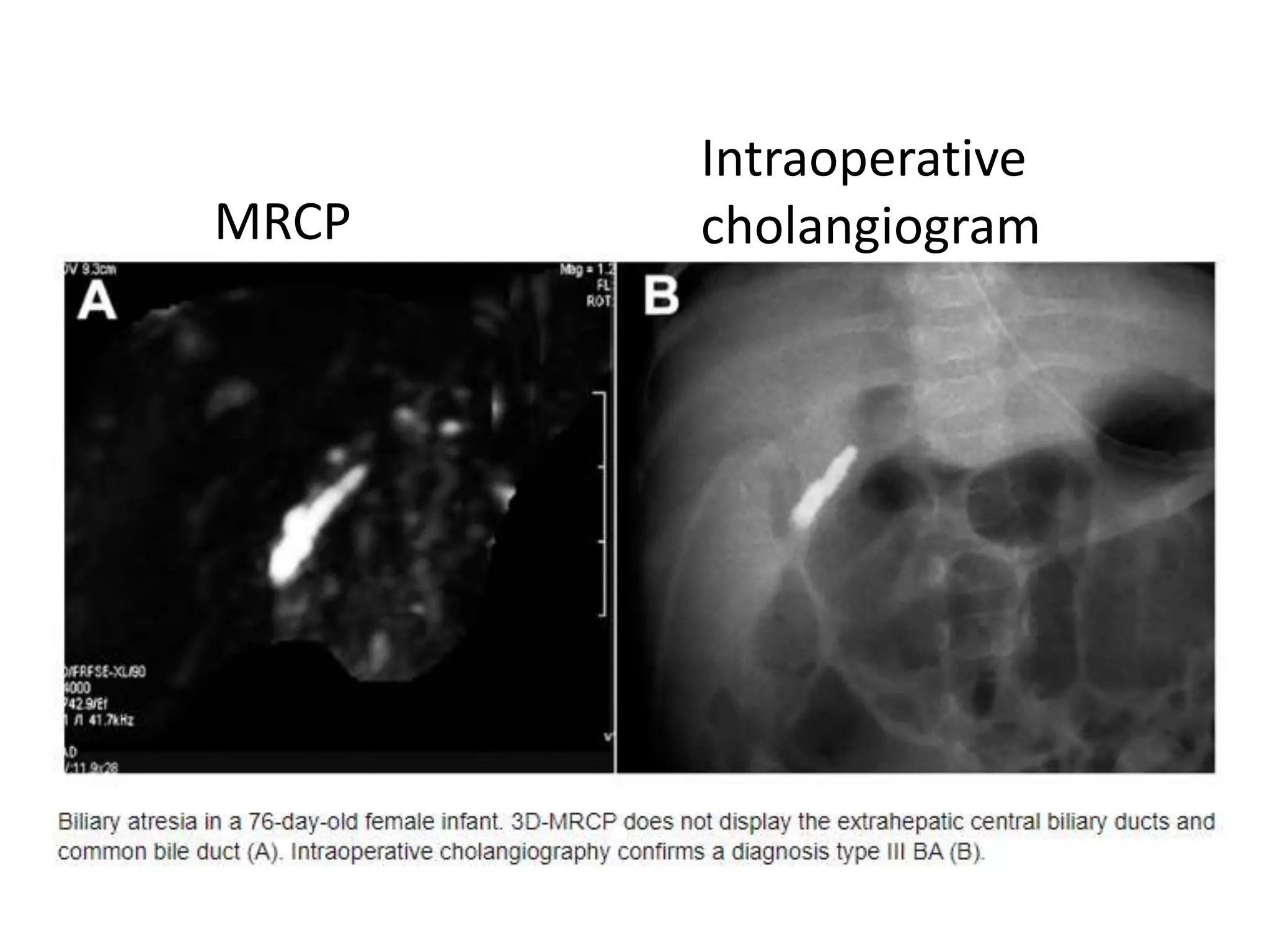 Anomalies of biliary tree | PPTX