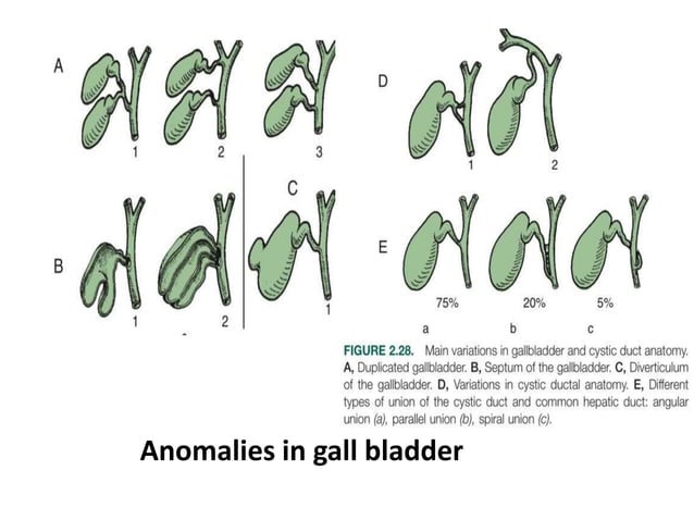 Anomalies of biliary tree | PPTX