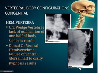 anomalies of caudal cell mass:anomalies of human spine.pptx