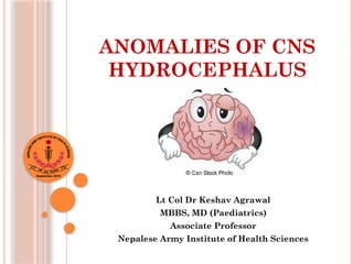 Anomalies of CNS+ Hydrocephalus in neonate.pptx