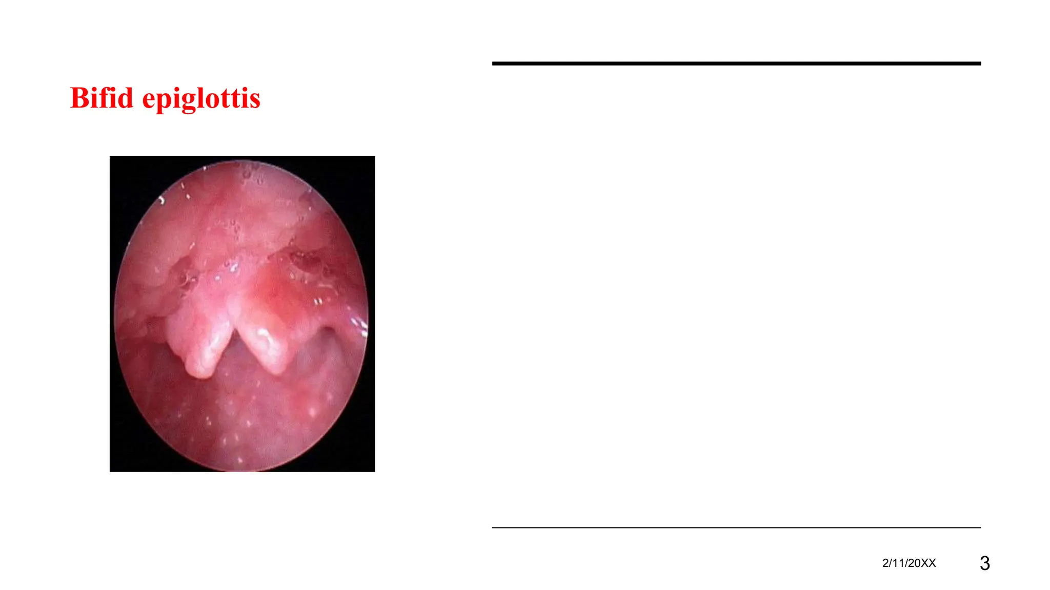 Anomalies of epiglottis case presentation .pptx