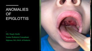 Anomalies of epiglottis case presentation .pptx