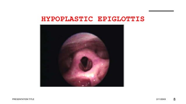 Anomalies of epiglottis case presentation .pptx