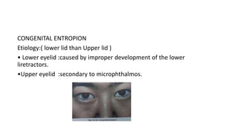 anomalies of eyemargin ophthalmology.pptx