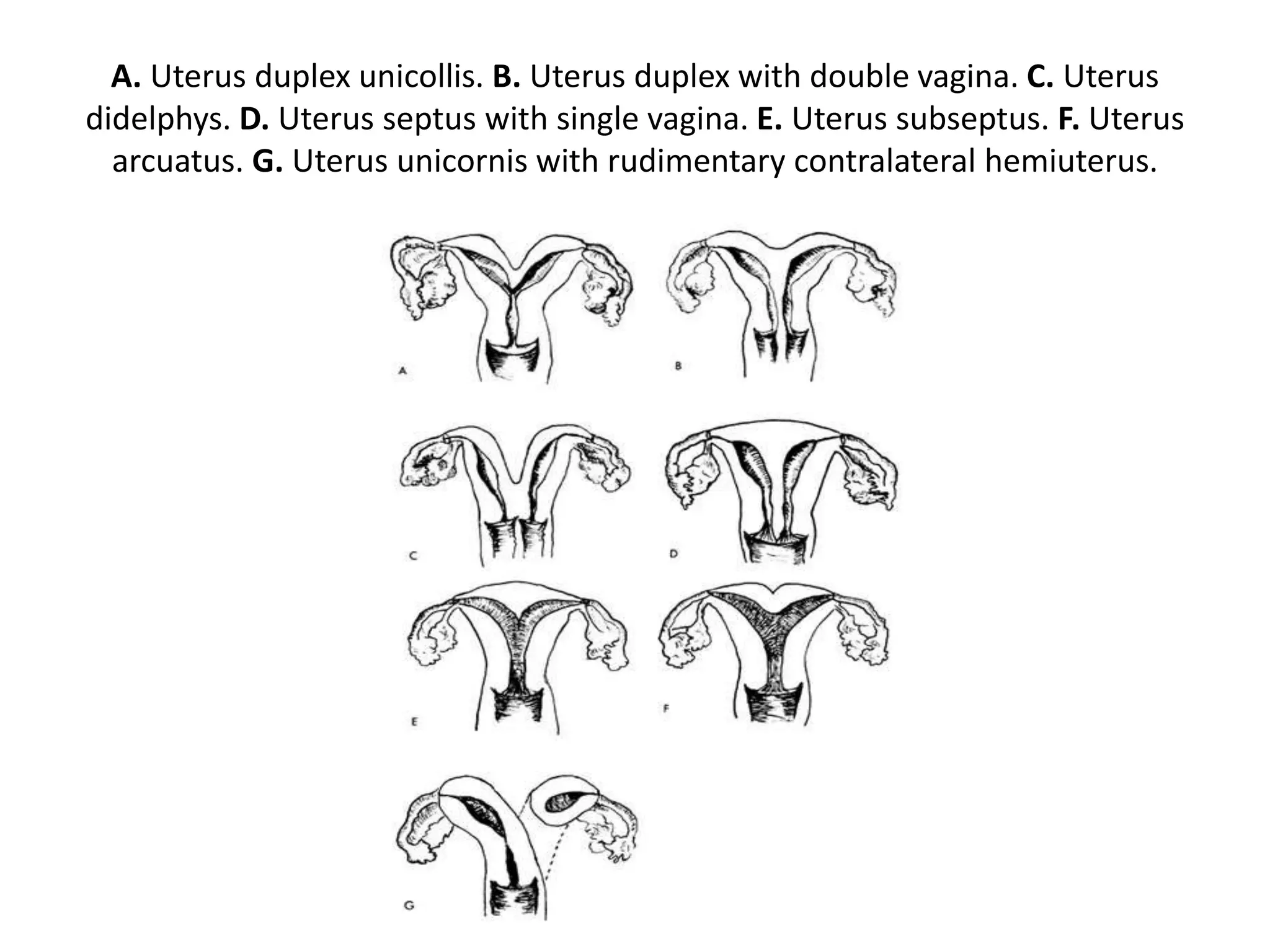 Anomalies of Female Reproductive System (Embryology-uterus, uterine ...