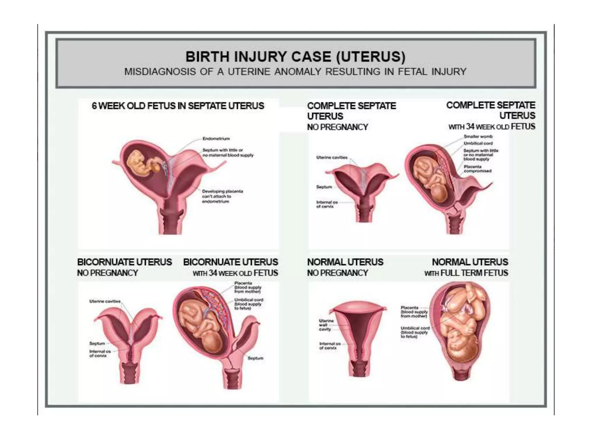 Anomalies of Female Reproductive System (Embryology-uterus, uterine ...