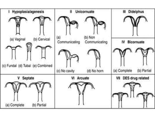 Anomalies of Female Reproductive System (Embryology-uterus, uterine ...