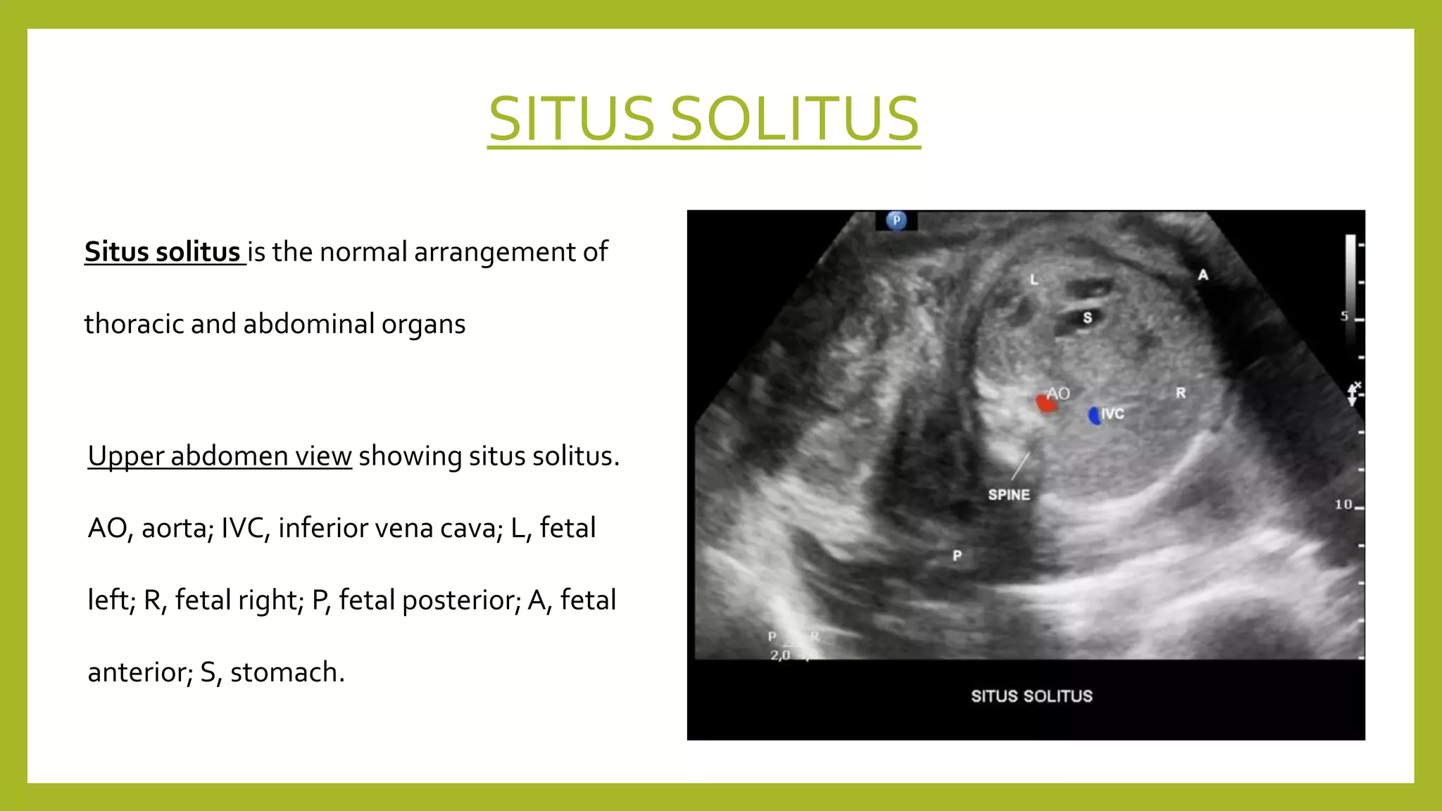 Anomalies of fetal cardiac system | PPTX
