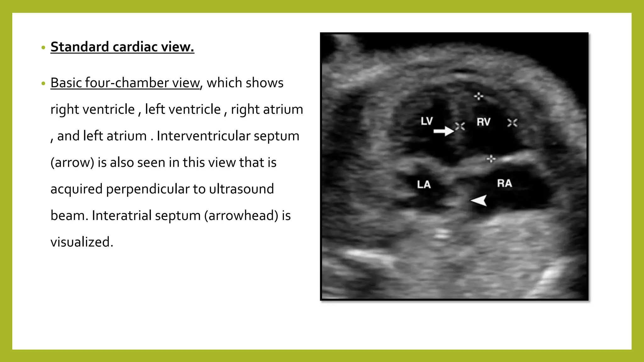 Anomalies of fetal cardiac system | PPTX