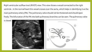 Anomalies of fetal cardiac system | PPT