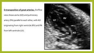 Anomalies of fetal cardiac system | PPTX