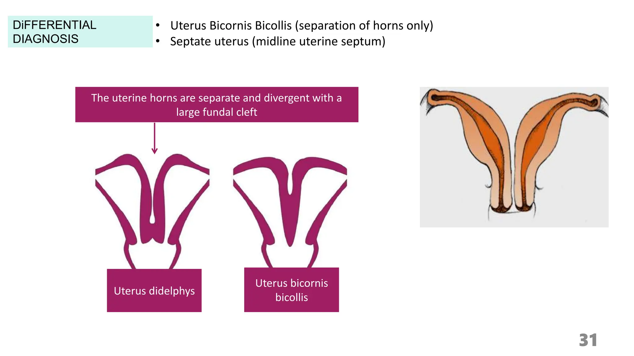 Congenital anomalies of female genital tract.pptx