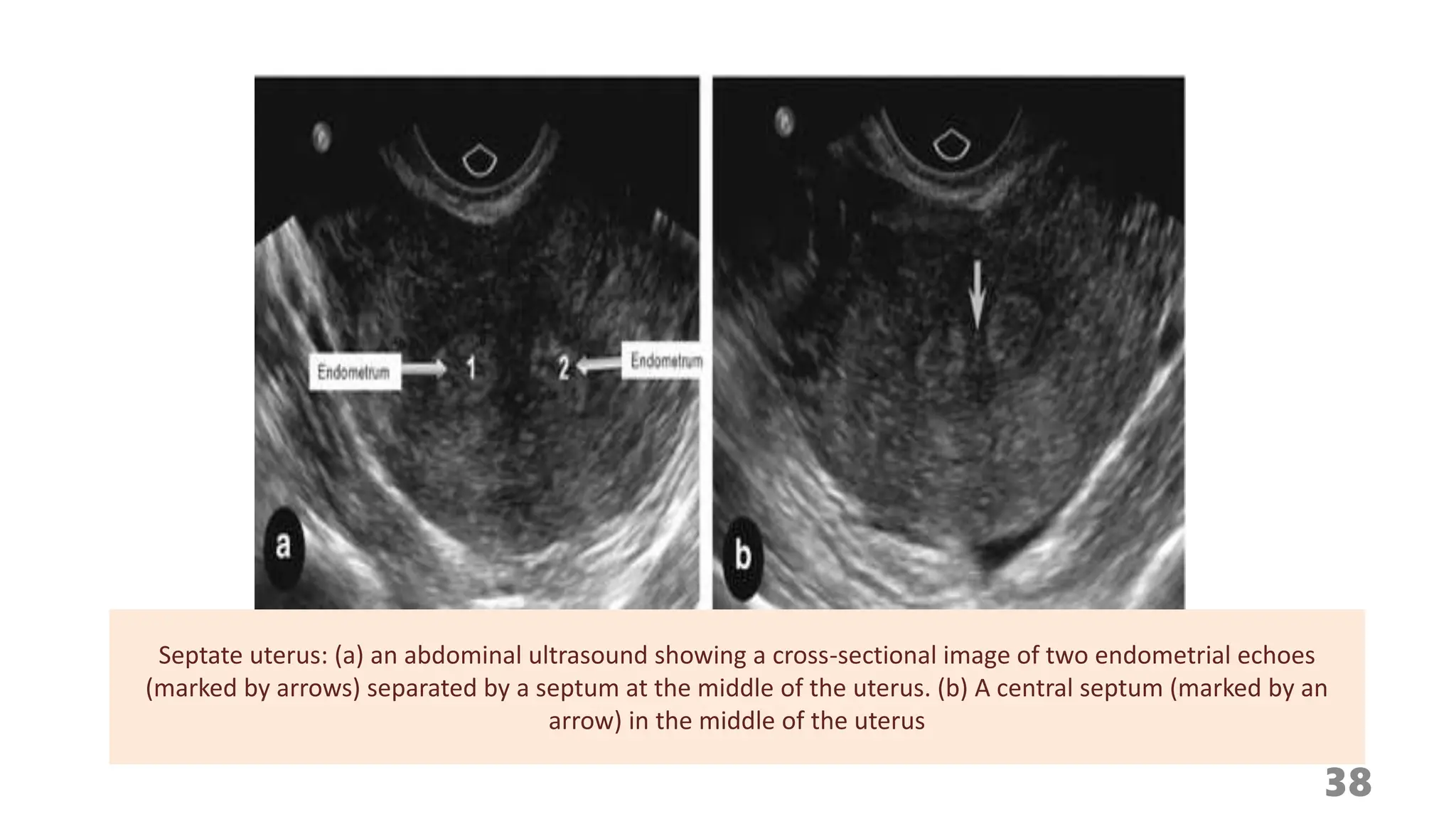 Congenital anomalies of female genital tract.pptx