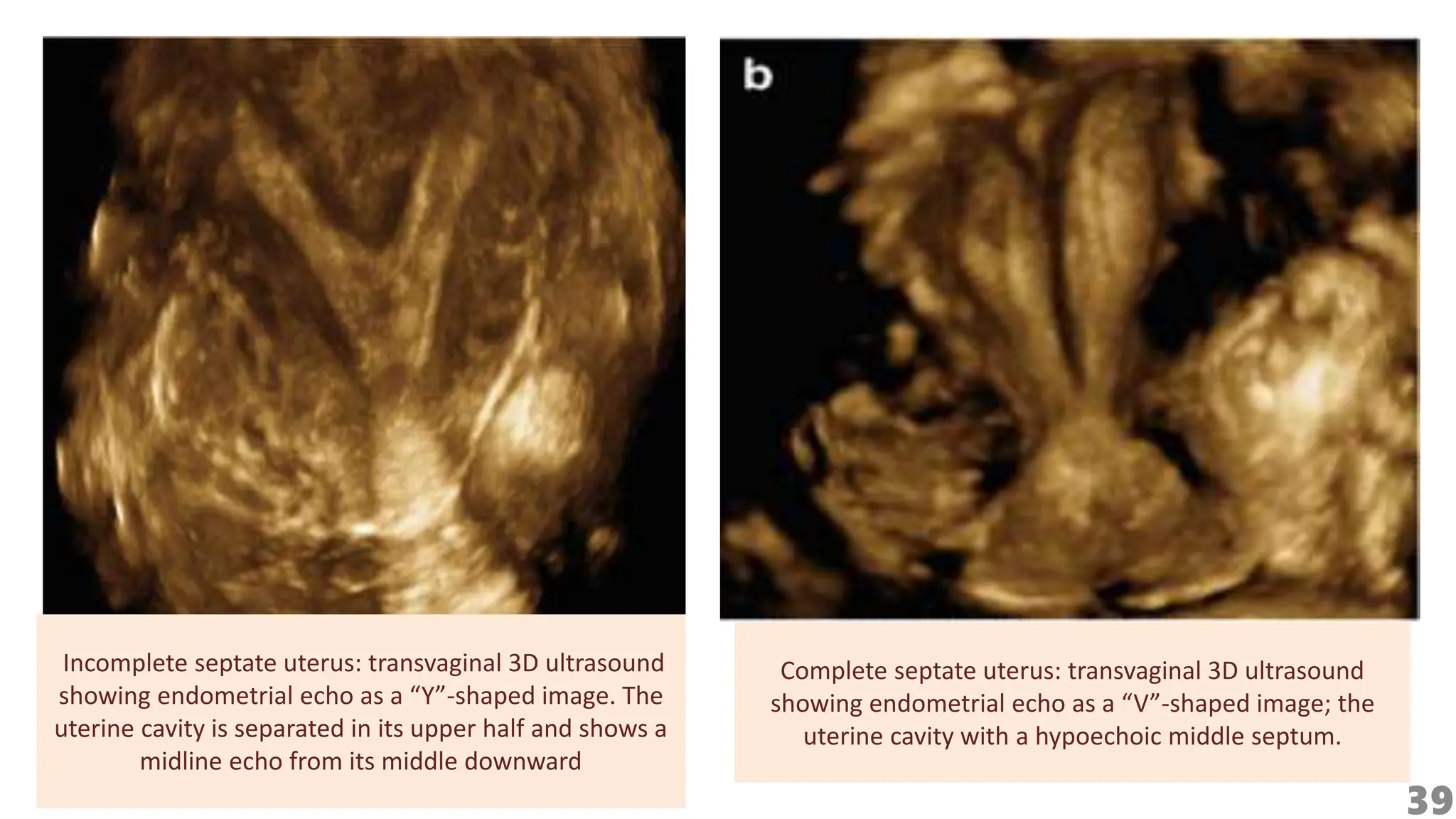 Congenital anomalies of female genital tract.pptx
