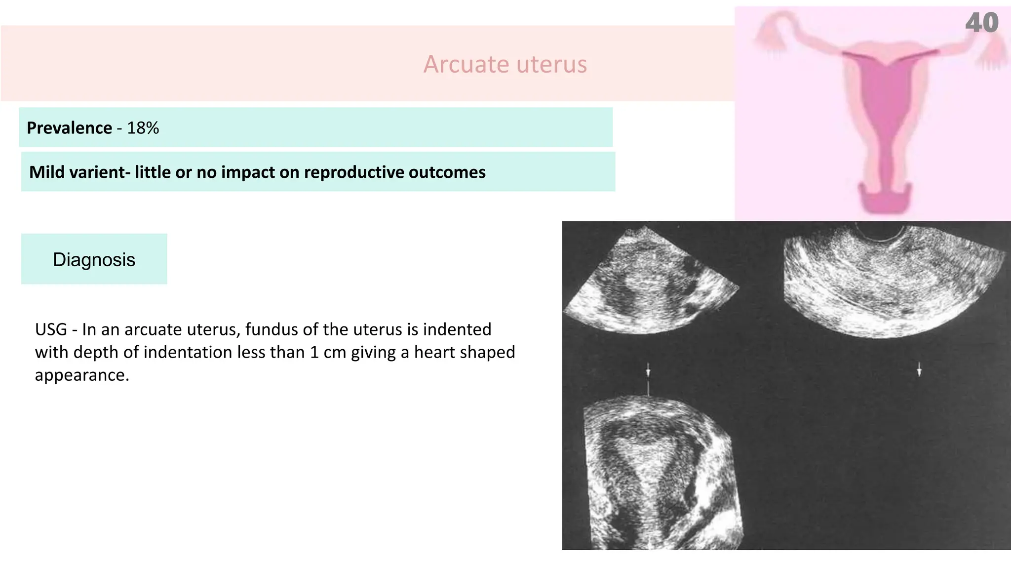 Congenital anomalies of female genital tract.pptx