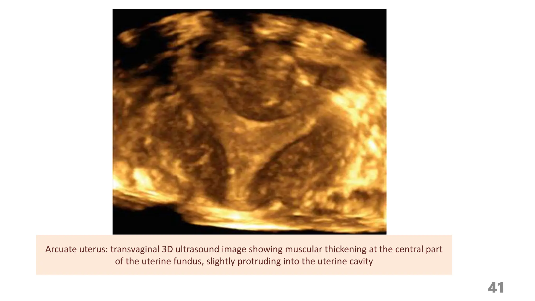 Congenital anomalies of female genital tract.pptx