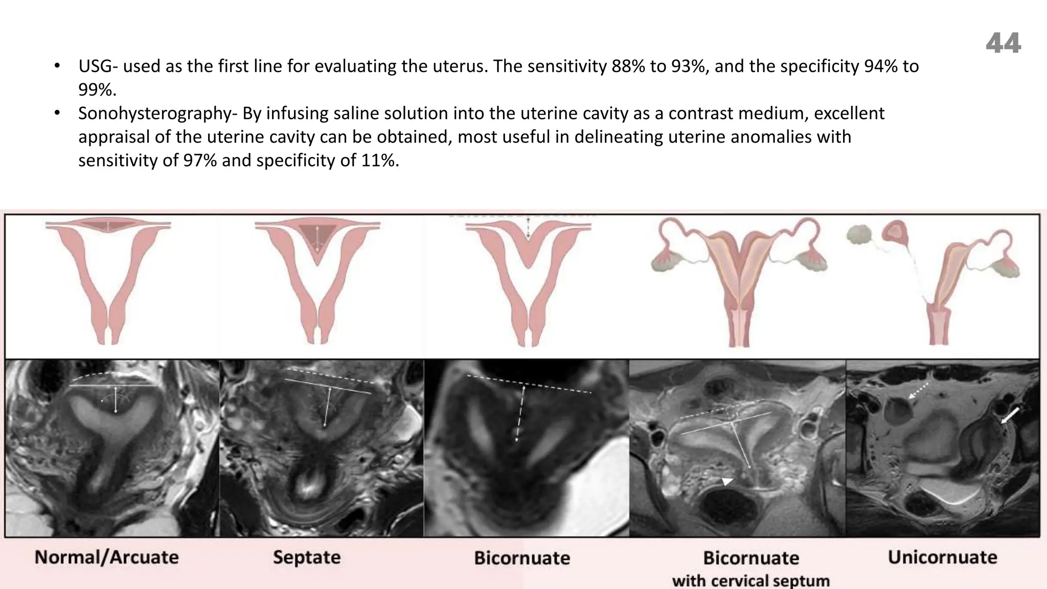 Congenital anomalies of female genital tract.pptx
