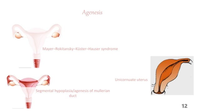 Congenital anomalies of female genital tract.pptx | Pregnancy ...