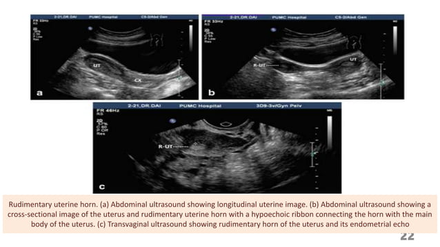 Congenital anomalies of female genital tract.pptx | Pregnancy ...