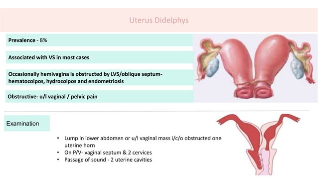 Congenital anomalies of female genital tract.pptx | Pregnancy ...