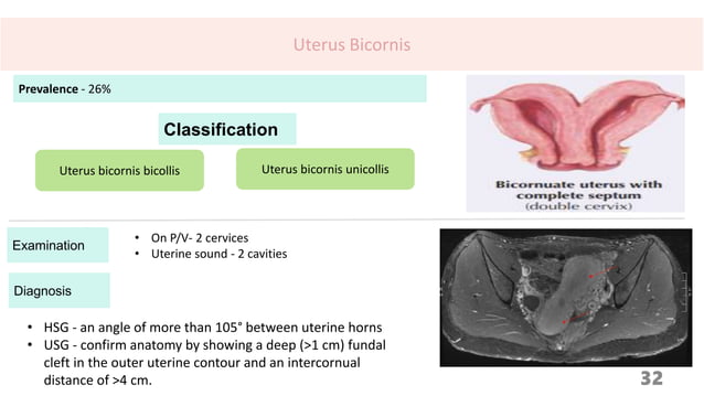 Congenital anomalies of female genital tract.pptx | Pregnancy ...