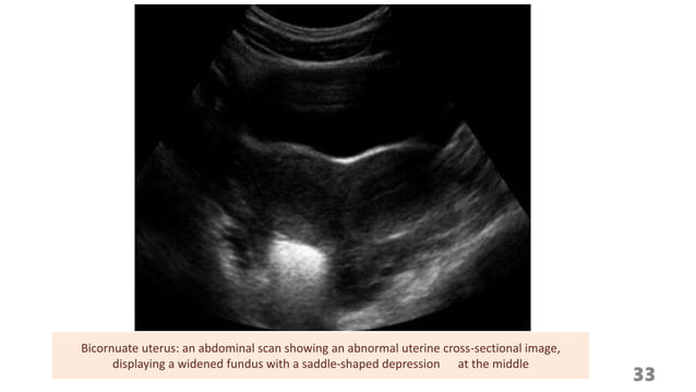 Congenital anomalies of female genital tract.pptx | Pregnancy ...