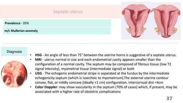 Congenital anomalies of female genital tract.pptx | Pregnancy ...