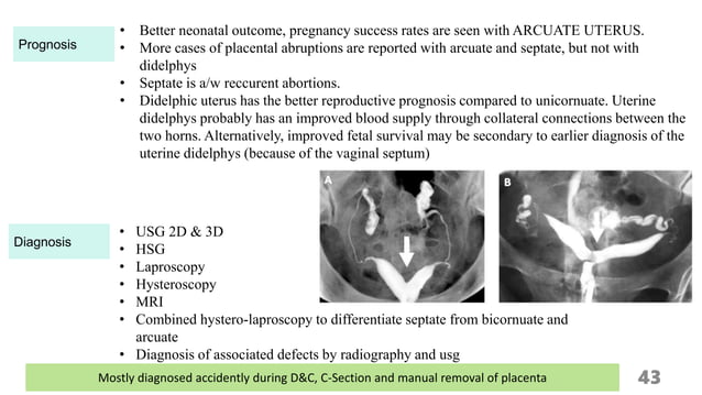 Congenital anomalies of female genital tract.pptx | Pregnancy ...
