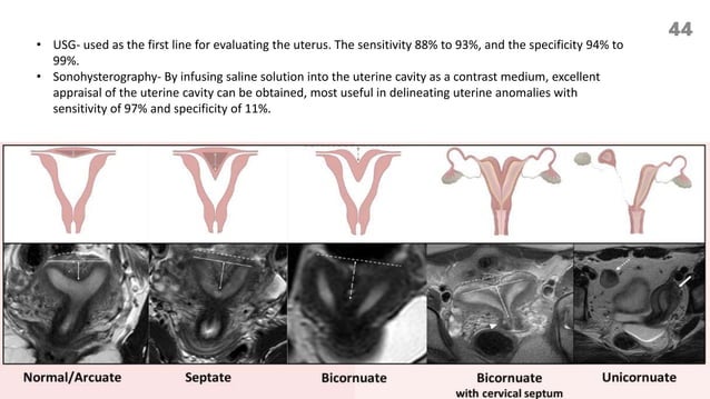Congenital anomalies of female genital tract.pptx | Pregnancy ...