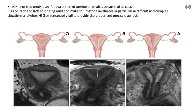 Congenital anomalies of female genital tract.pptx | Pregnancy ...