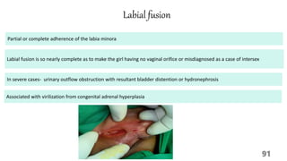 Congenital anomalies of female genital tract.pptx