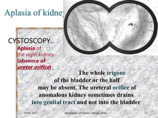 Anomalies of Genito-Urinary Tract.ppt
