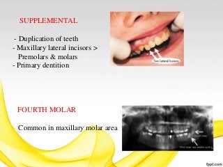 Developmental Anomalies Of Teeth | PPTX